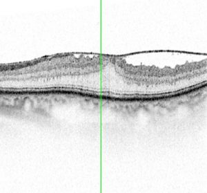 Epiretinale Membranbildung (Gliose) - Augenpraxisklinik Heidelberg